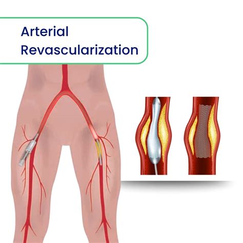 Arterial Revascularization In Brooklyn New York Downtown Vein And Vascular