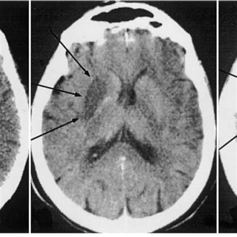 Acute Ischemic Stroke Lesion Segmentation In Non Cont Vrogue Co