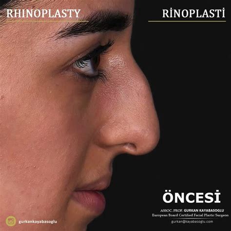 Before And After Rhinoplasty Surgery Video RealSelf