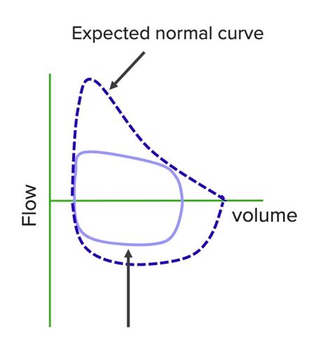 Tracheomalacia Flow Volume Loop Tracheomalacia Flow Volume Loop