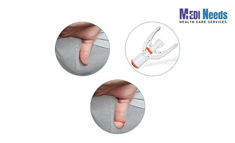 Circumcision