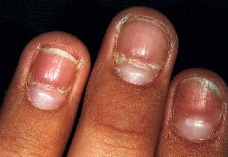 Vertical Ridges In Fingernails Vitamin Deficiency Awesome Nail