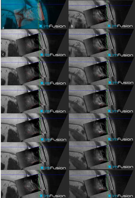 Acl And Anterolateral Meniscus Detection For 90 Degrees Knee Flexion