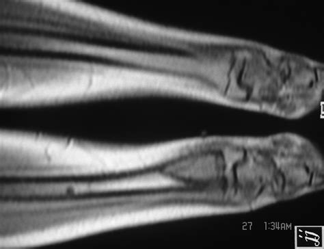 Distal Tibial Cyst Radiopaedia