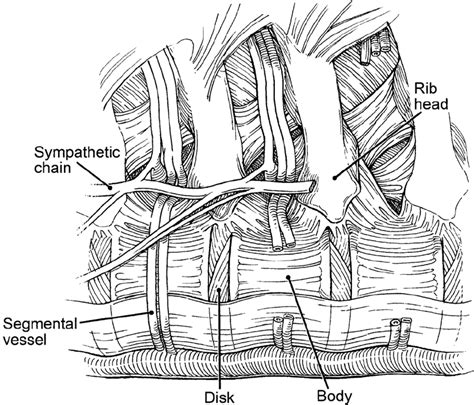 Thoracoscopic Approach Neupsy Key