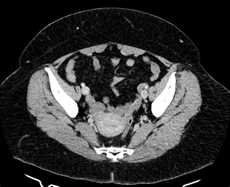 File Choledocholithiasis Cholangitis And Portal Vein Thrombophlebitis