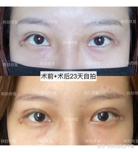 国内北京双眼皮修复医生哪个好？金鑫、黄寺刘玲、刘学源、八大处王太玲、韩新鸣、协和朱琳、韩勋 知乎