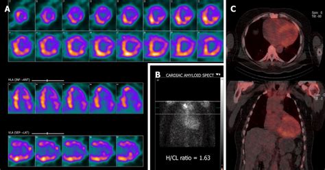 tc 99m pyrophosphate spect of the chest with computed tomography