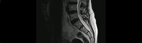 S1 Spine Common Problems And Treatment Options