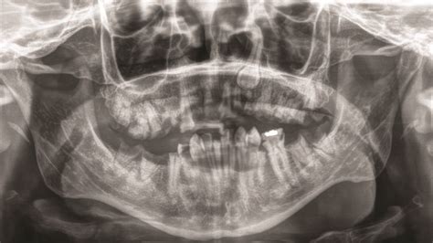 Brain Abscess Of Dental Origin Oral Health Group