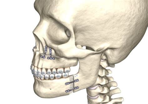 Jaw Surgery Correcting Misalignment And Improving Oral Function