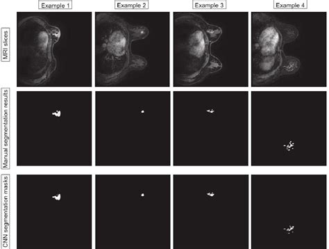 Figure From Development And Validation Of A Deep Learning Model For Breast Lesion Segmentation