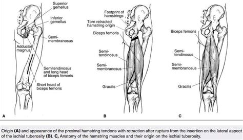 Pulled Hamstring Diagram