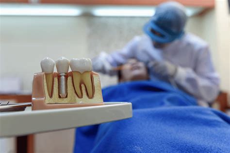 Demystifying Dental Implants A Comprehensive Guide To This Dental