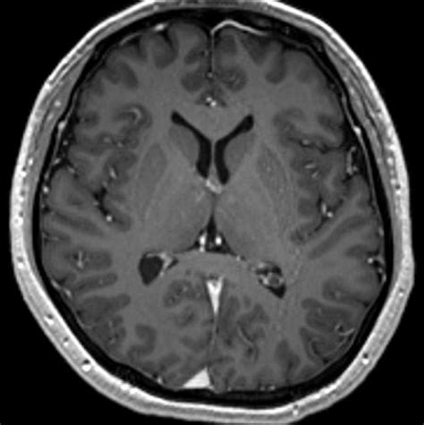 Choroid Plexus Xanthogranuloma Neuro Mr Radiology Case Studies