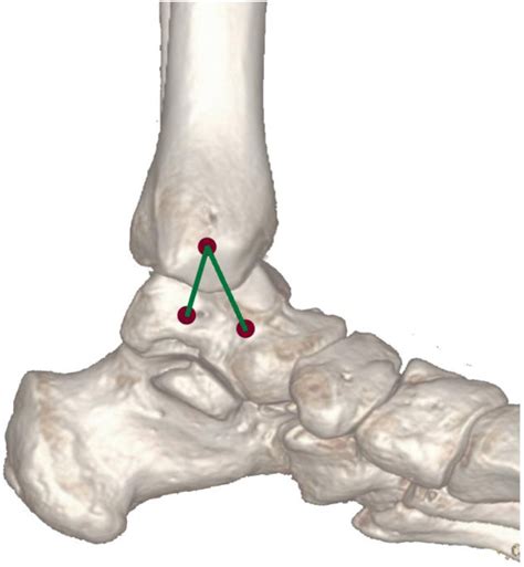 Deltoid Ligament Ankle Sprain