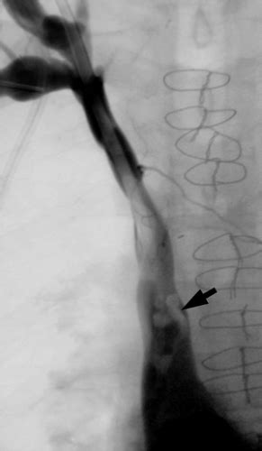 Venous Diseases Thoracic Key