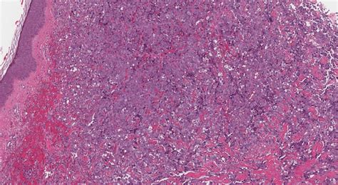 Epithelioid Angiosarcoma Ottawa Atlas Of Pathology