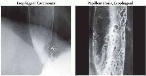 Da3 Db1 Mucosal Nodularity Esophagus Ffu5  Abdominal Key