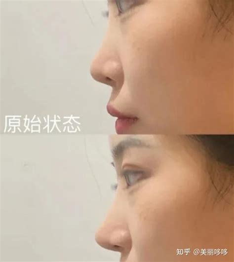 想做隆鼻却不知道如何选择医生，了解完这些内容后就清楚怎么寻找了 知乎