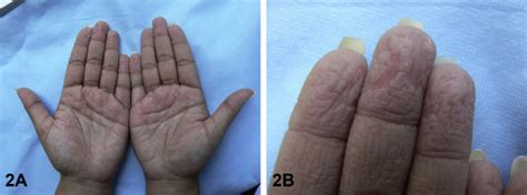 Excessive Wrinkling Of The Palms After Brief Water Immersion Jaad