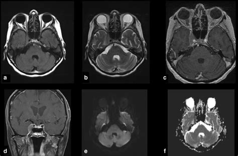 Access To Meckels Cave For Biopsies Of Indeterminate Lesions A