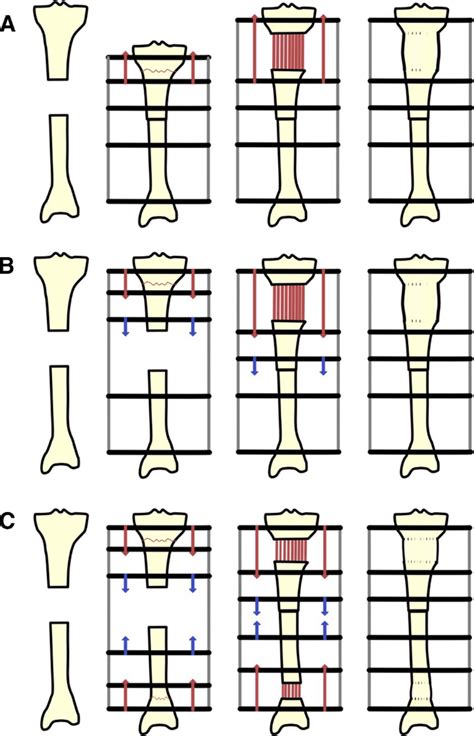 使用外固定器进行骨运输后的对接部位干预文献的系统回顾 International Orthopaedics X MOL