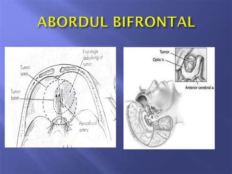 PPT Abordul Neurochirurgical Al Bazei Craniului PowerPoint