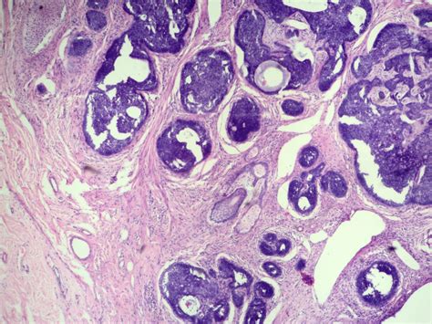 1546325 X Trichoblastoma Large Nodular Type Mature Hair … Flickr