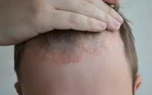 Scalp Psoriasis Plaques Vs Other Scalp Conditions