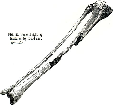 Landmarks General Sickles Leg