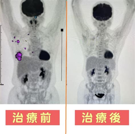 長期高壓易患乳癌！57歲女主管乳頭出現分泌物、異味 檢查已是乳癌末期