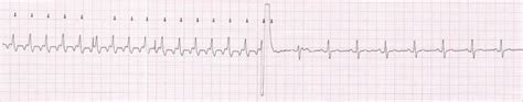 Atrial Flutter Thoracic Key Atrial Flutter Thoracic Key