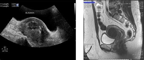 Ultrasound Pictures Of Uterine Fibroids Or Mri How To Diagnose Better