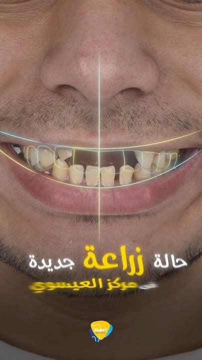 حالة زرعه و تجميل جديده من مركزنا Youtube
