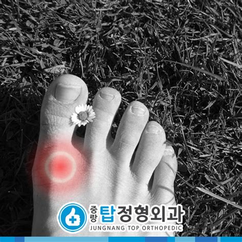 상봉동정형외과 면목동정형외과 엄지발가락이 휘어지고 통증이 나타나는 무지외반증 네이버 블로그