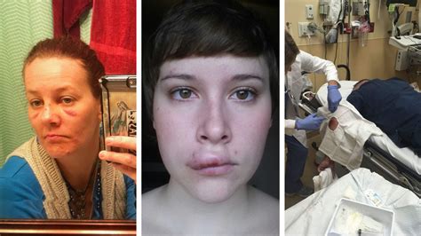 Nurses Say Attacks By Patients Getting Worse