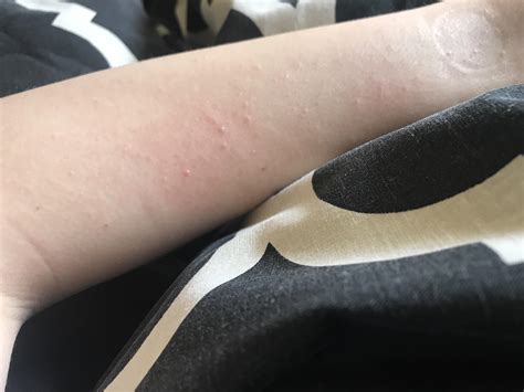How Do You Get Rid Of These Spots And What Are They R SkincareAddicts
