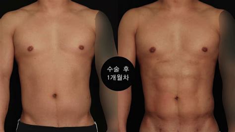 전문의가 설명하는 복근성형술의 적합한 대상 Youtube