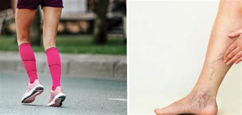 How To Stop Itching From Compression Socks Detailed Guide