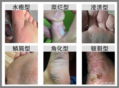 脚痒起水泡怎么办？ 知乎