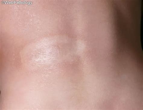 Localized Scleroderma Morphea