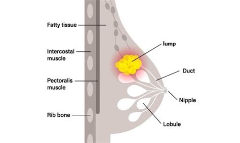 Breast Lump Treatment In Gurgaon Ck Birla Hospital