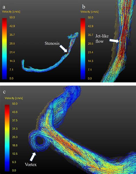 Blood Flow Pattern Of Venous Pulsatile Tinnitus Pt Streamline A Download Scientific