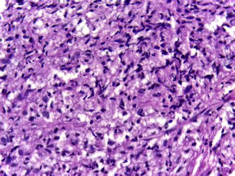 Leprosy Cases Reported In 28 Of Mexicos 32 States
