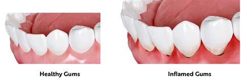 Why Are My Gums Swollen Dallas Dental Group
