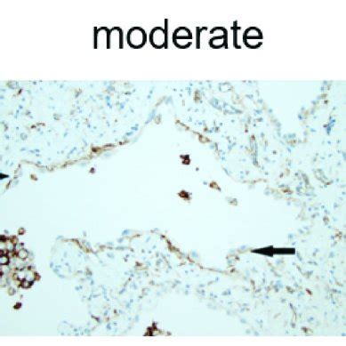 Membranous PD L1 Expression In Parenchymal Epithelial Cells PD L1