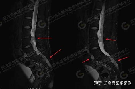 神经纤维瘤病1型一例【高尚医学影像】 知乎