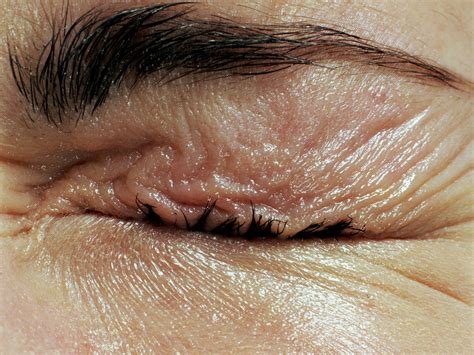 10 Blepharitis Symptoms To Know Signs Of This Bizarre Condition Self