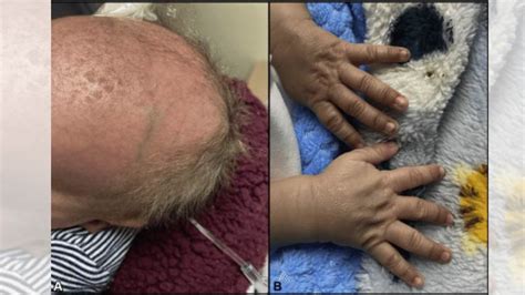 Romantica HD Tratan raro caso de enfermedad de Menkes en paciente pediátrico con micrognatia en